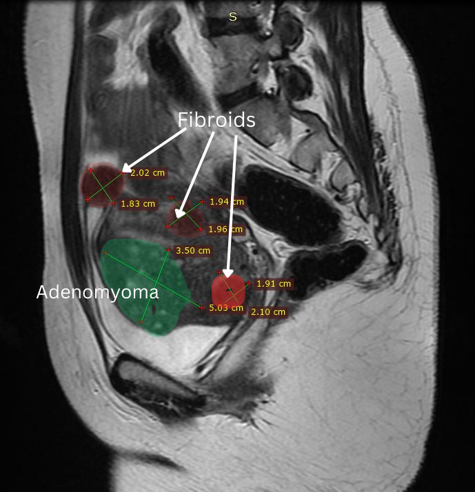 Spotlight On: Fibroids - NewsScope